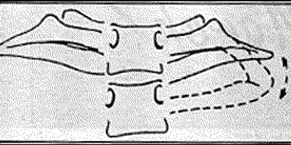 Fixation of the First Rib | Dynamic Chiropractic