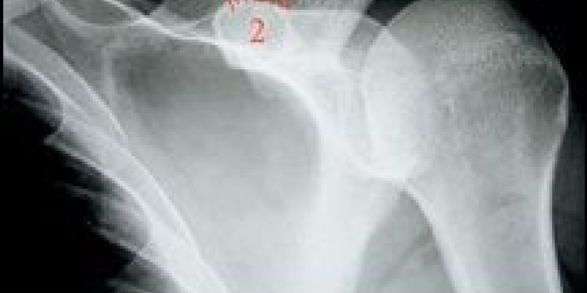 Radiographic Evaluation of the Separated Shoulder | Dynamic Chiropractic