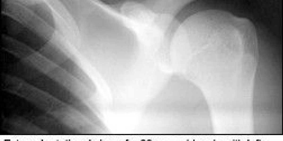 Posttraumatic Osteolysis of the Clavicle | Dynamic Chiropractic