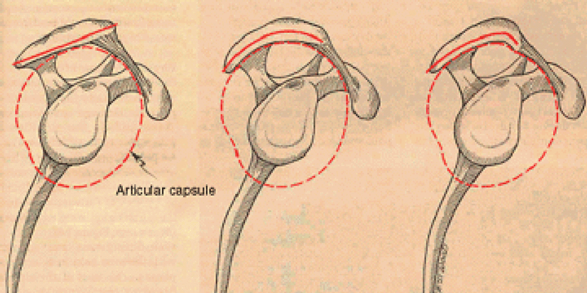 Shoulder Impingement Syndromes | Dynamic Chiropractic