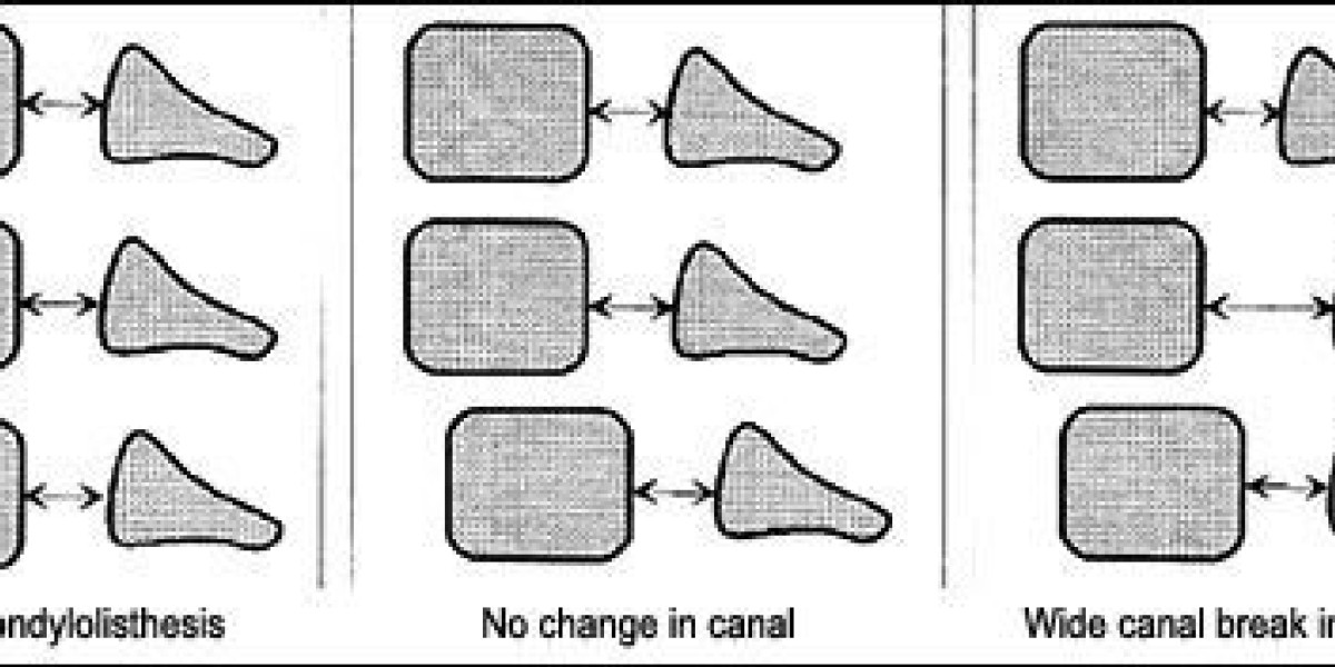 Isthmic vs. Degenerative Spondylolisthesis: Using the "Wide Canal Sign ...