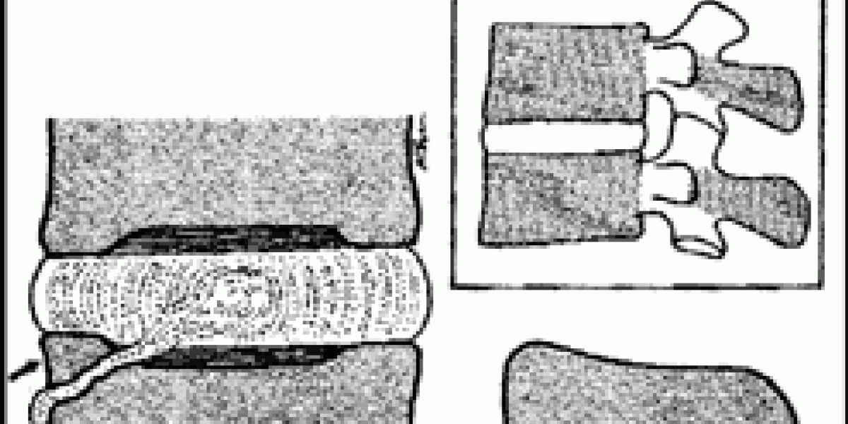 Limbus Vertebrae | Dynamic Chiropractic