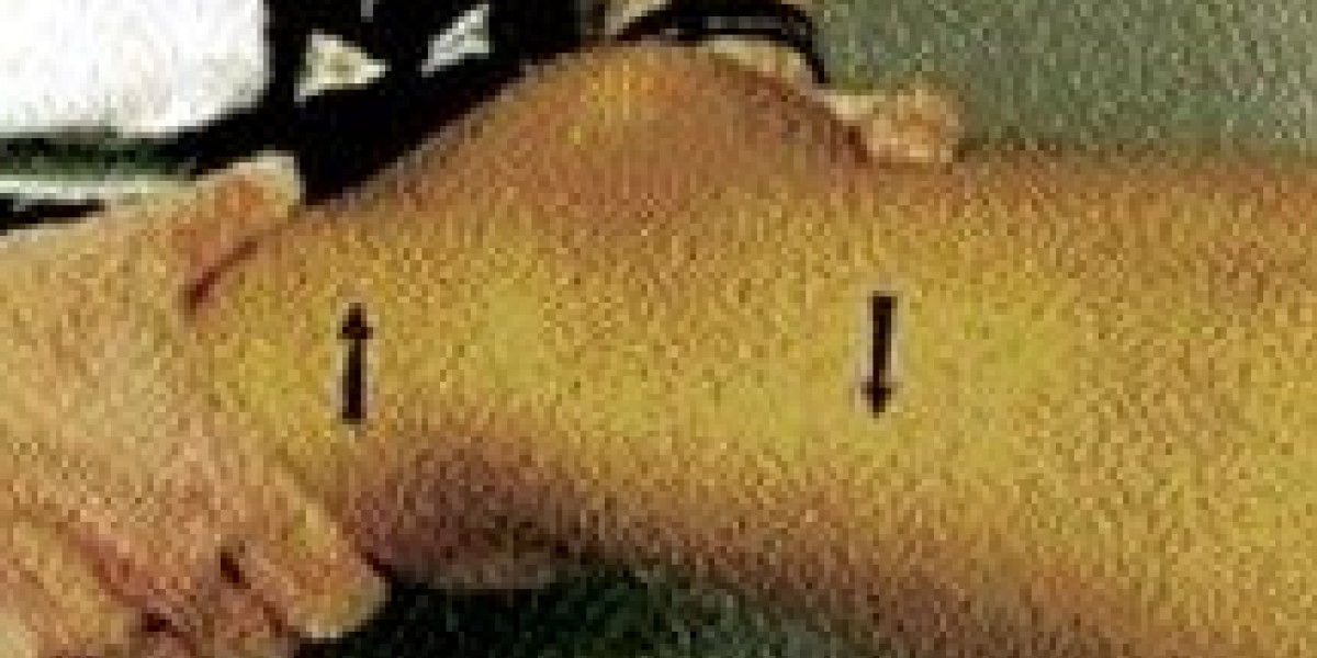 Anterior Cruciate Ligament Tear | Dynamic Chiropractic