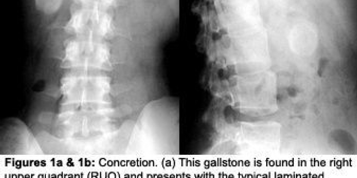 A Review of Abdominal Calcifications | Dynamic Chiropractic